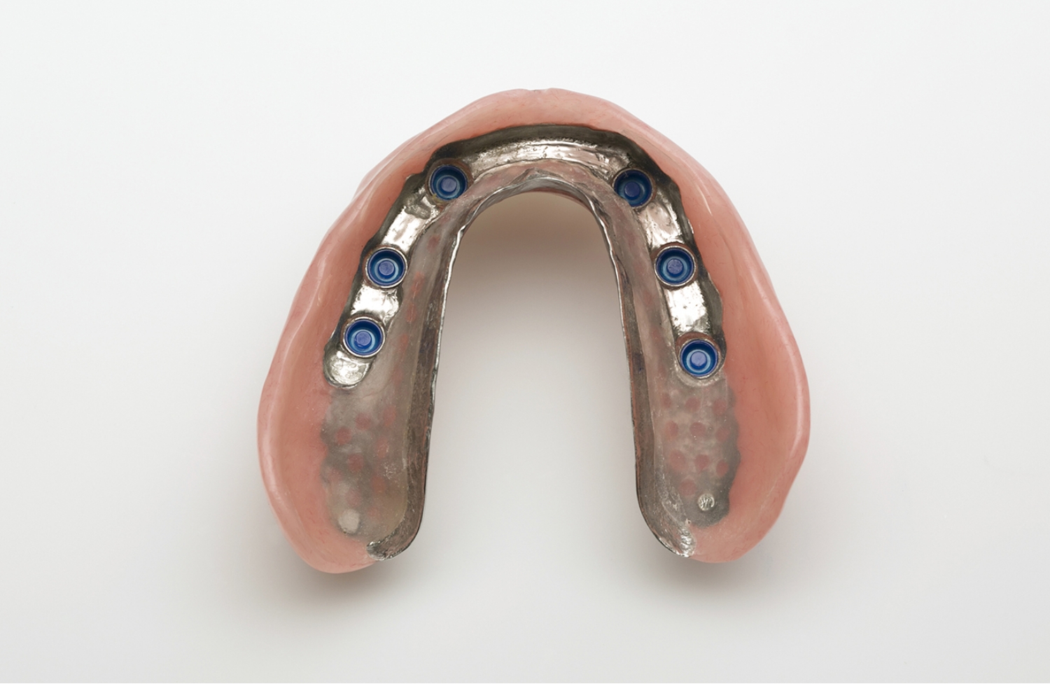 Overkappingsprothese - Dental Labo Vanderbeken