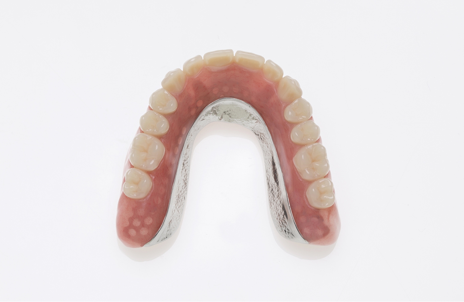 Overkappingsprothese - Dental Labo Vanderbeken